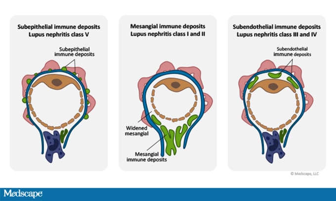 Specialist Perspectives on SLE Management: Approaches to Integrating Care