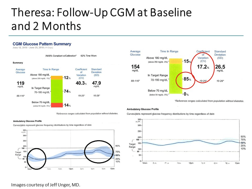 Hypoglycemia Reduction Using the Newest CGM Technology