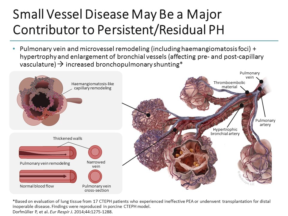 Clinical Comparisons in CTEPH: Assessing Trials, Updates and ...