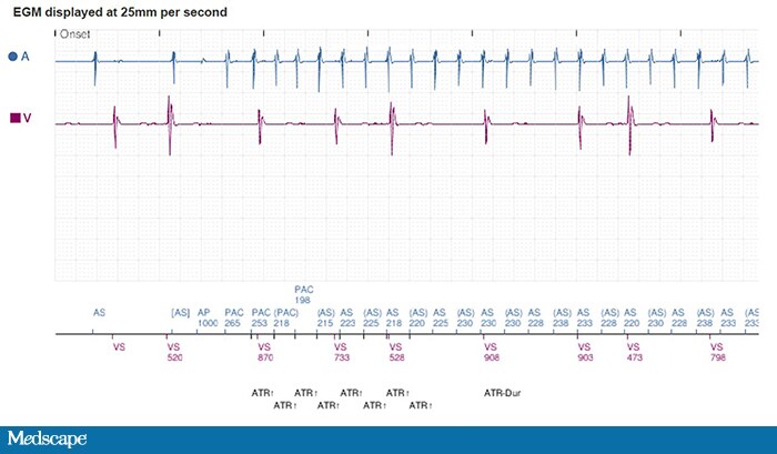 A 79-Year-Old Woman With a Pacemaker and High Atrial Rates