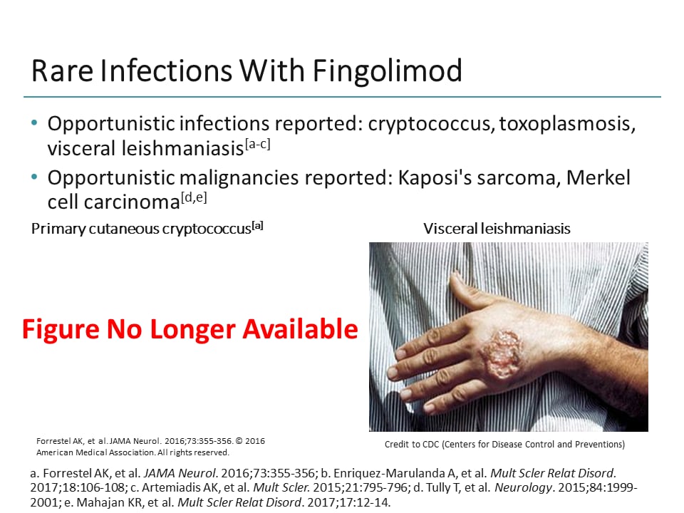 Mitigating Infection Risk With DMT in MS: Now and in the Future