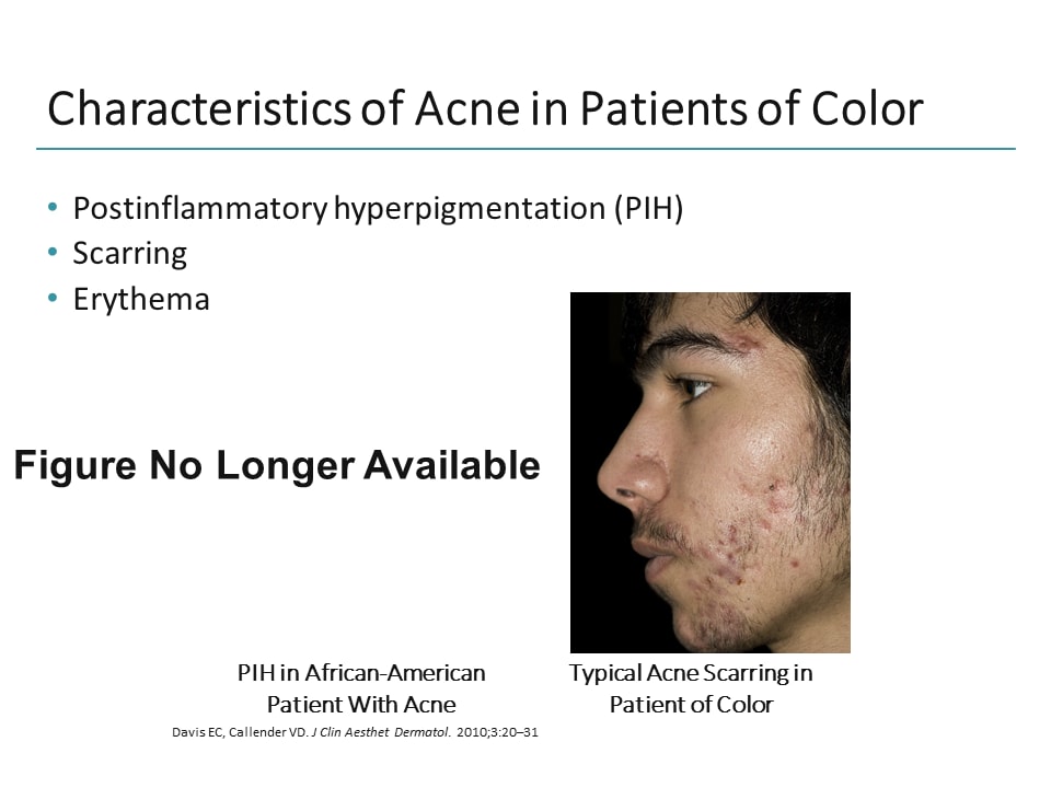 Ask the Experts in Acne Management: Special Considerations for Acne in ...