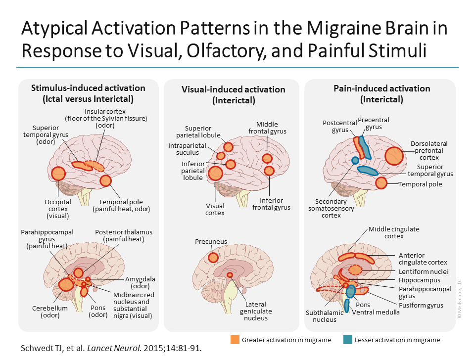 The Biologic Basis of Migraine (Transcript)