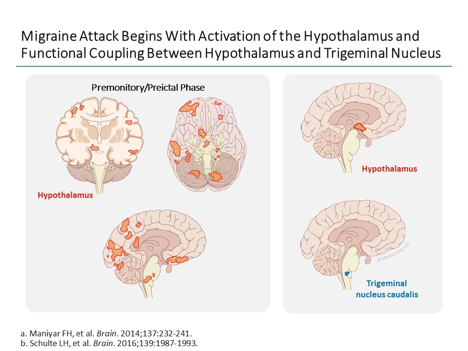 The Biologic Basis of Migraine (Transcript)
