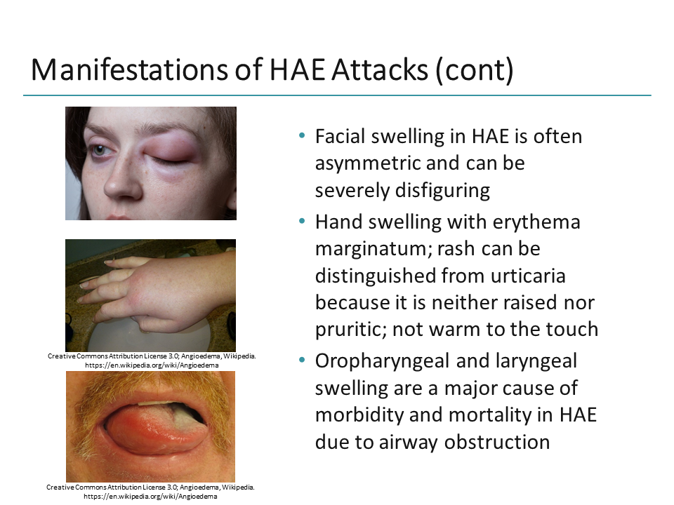 Navigating the Journey: Patient Perspectives on Hereditary Angioedema ...