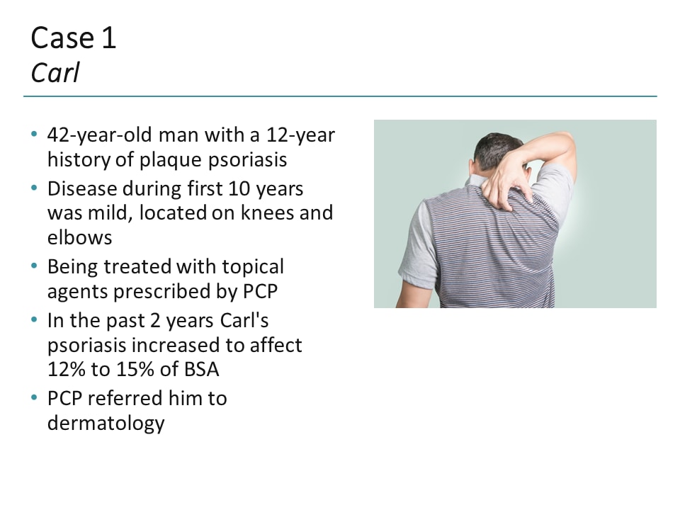 Ask the Psoriasis Expert: Practice Pearls in Moderate to Severe Cases