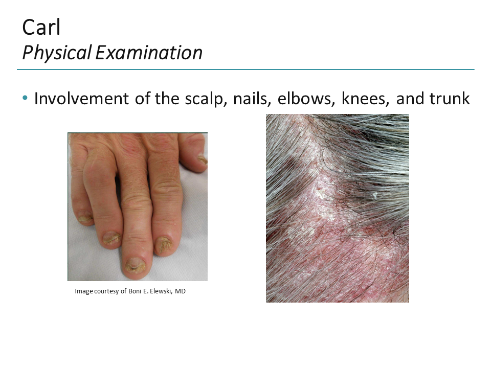 Ask the Psoriasis Expert: Practice Pearls in Moderate to Severe Cases