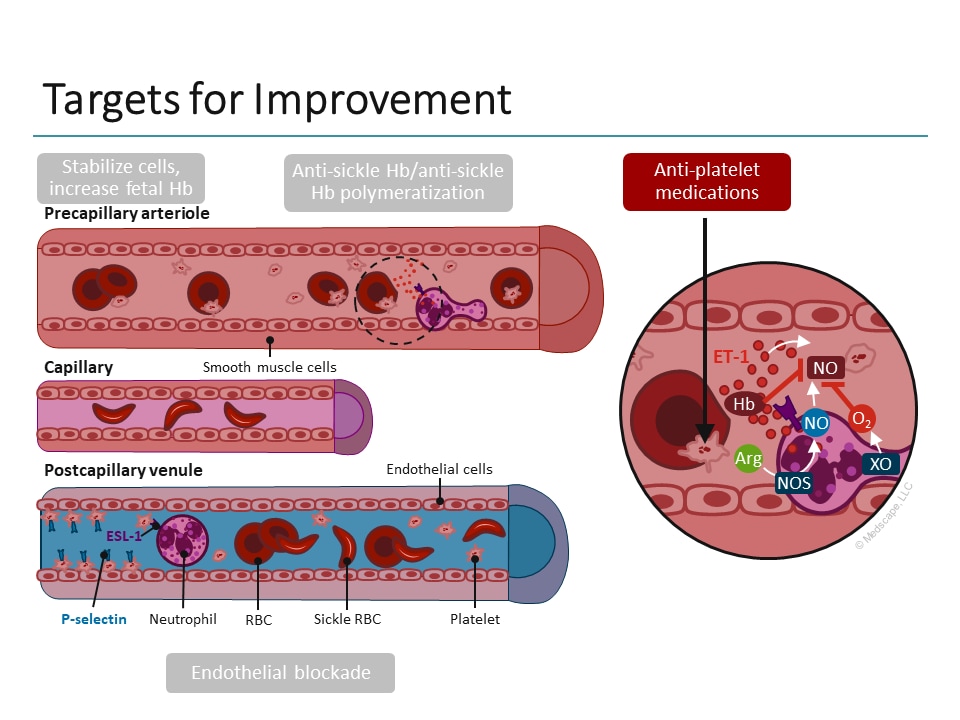 Updates on Sickle Cell Disease