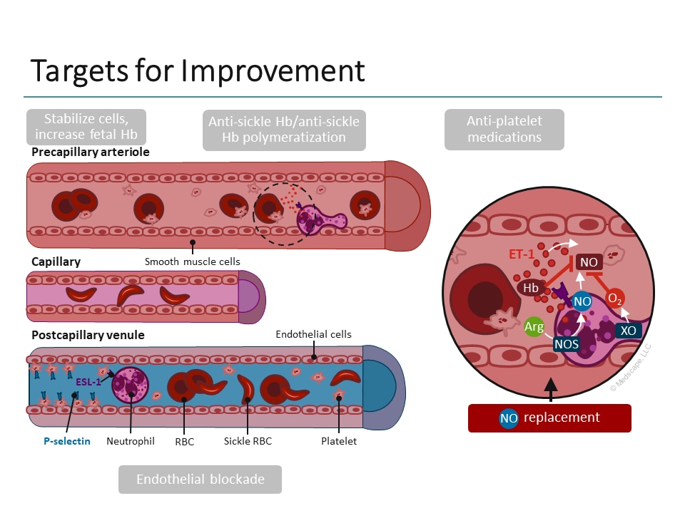 Updates on Sickle Cell Disease