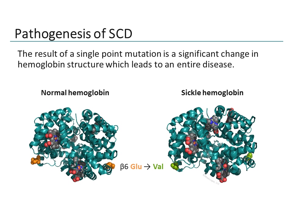 Updates on Sickle Cell Disease