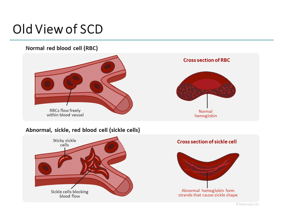 Updates on Sickle Cell Disease