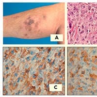 The 2018 Update of the WHO-EORTC Classification for Primary Cutaneous ...