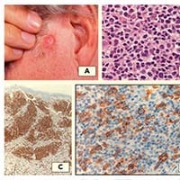 The 2018 Update of the WHO-EORTC Classification for Primary Cutaneous ...