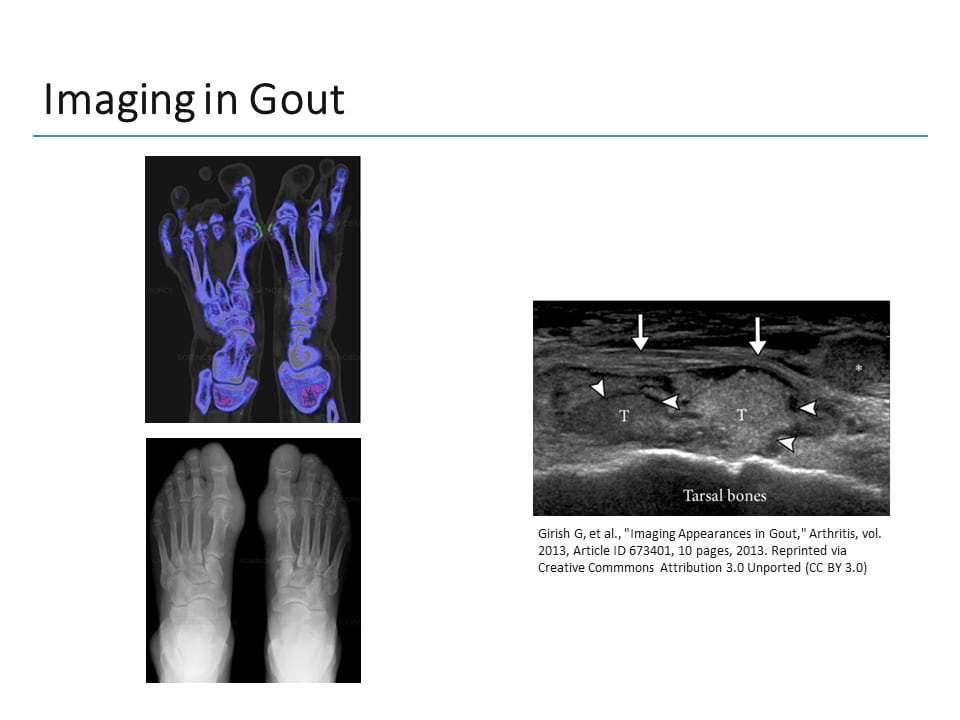 Optimizing Treatment of Refractory Gout