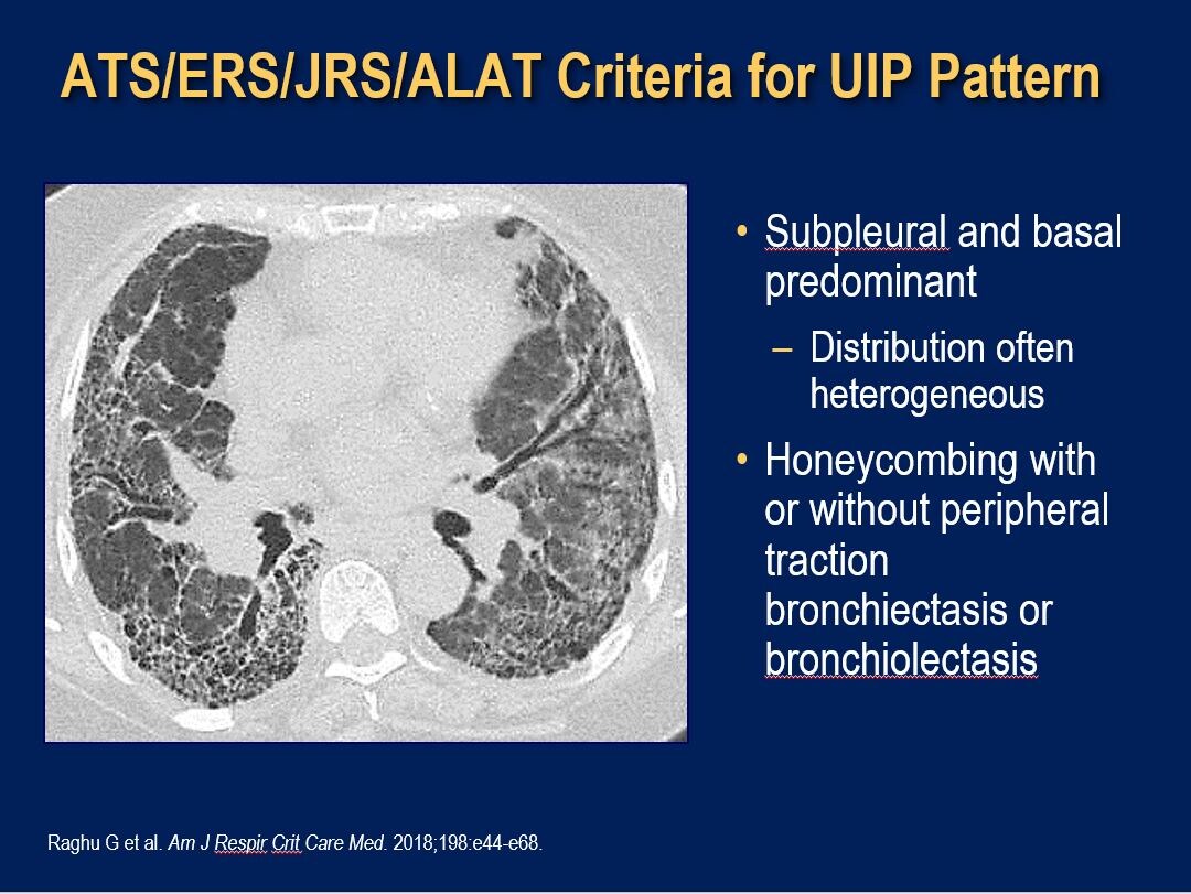 Diagnosing and Assessing IPF: Role of the Radiologist