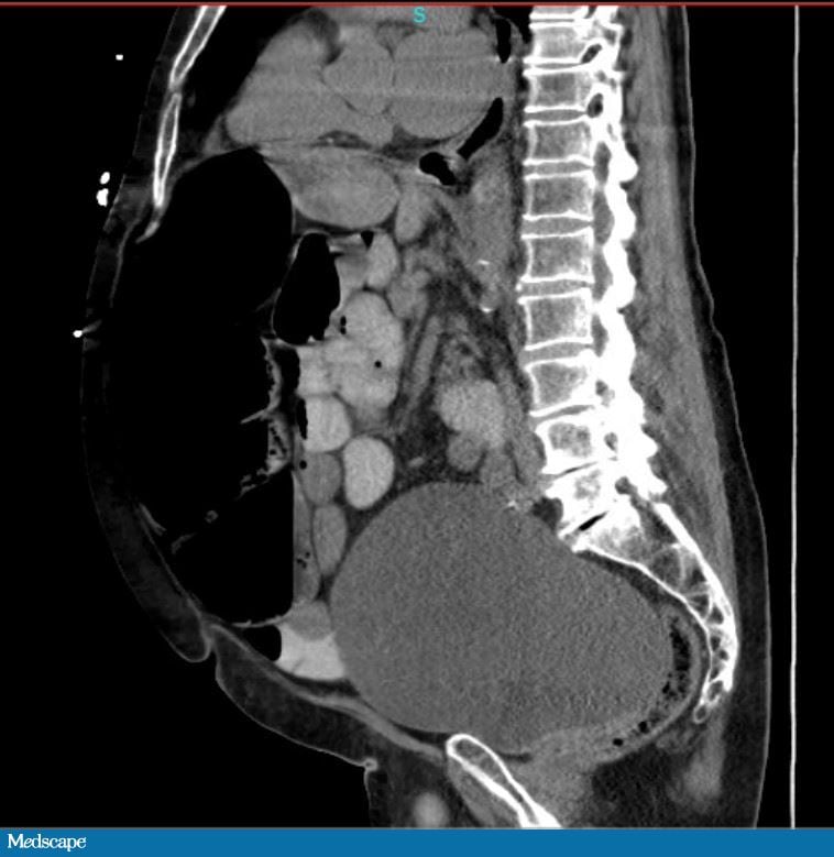 A 65-Year-Old Man With a Hugely Distended Abdomen - Page 2