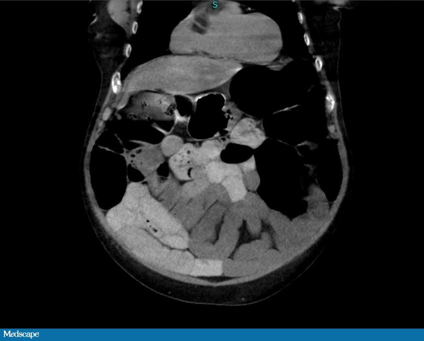 A 65-Year-Old Man With a Hugely Distended Abdomen - Page 2