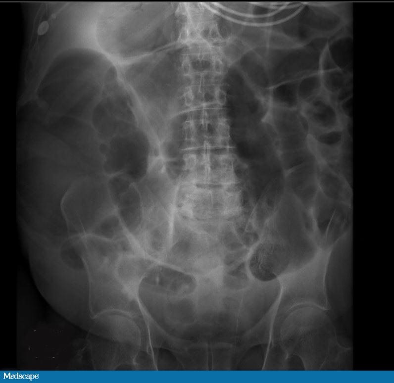 A 65-Year-Old Man With a Hugely Distended Abdomen - Page 2