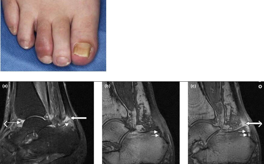Stay or Go? When to Switch Treatments in Psoriatic Arthritis