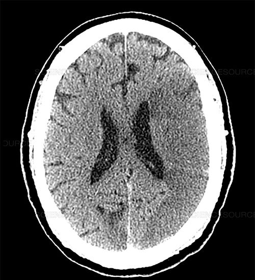 A Quick Primer in Large Hemispheric Stroke: Recognition and Management ...