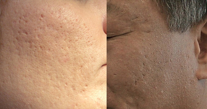 Are You an Expert? Managing Difficult Cases in Truncal Acne