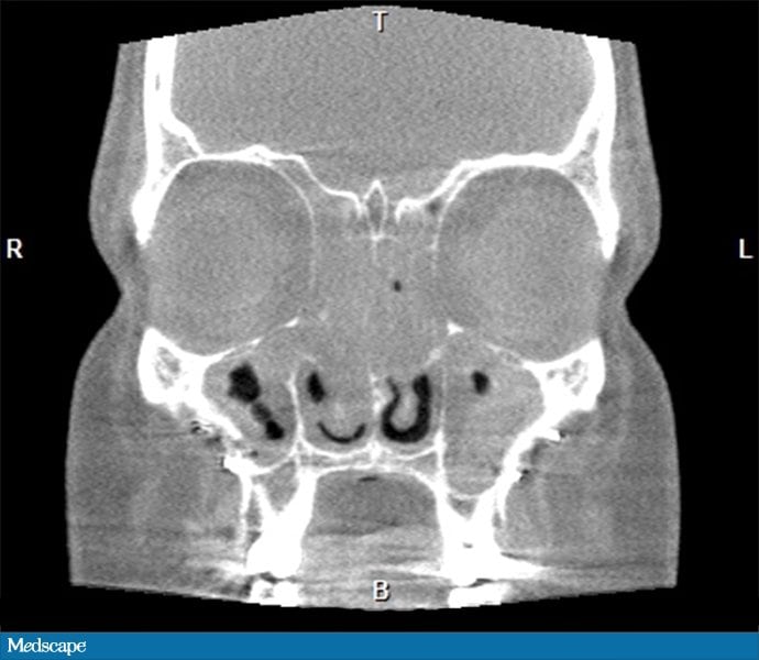 Beer, Aspirin Worsen Nasal Issues in a 35-Year-Old With Asthma - Page 2