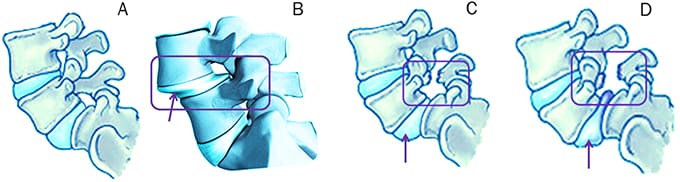 Determining the Optimal Management Strategy for Degenerative ...