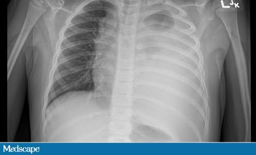 An 8-Year-Old Boy With Autism, Lupus, Fever, and Chest Pain
