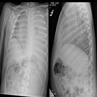 An 8-Year-Old Boy With Autism, Lupus, Fever, and Chest Pain - Page 2