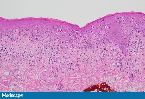 A Rash on Nearly Half of His Body for Years - Page 2