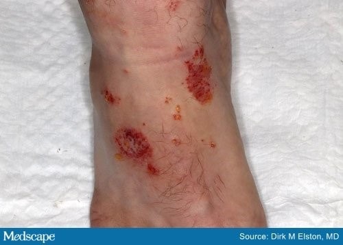 29-Year-Old Hiker Self-Treats Her Rash With Coconut Oil