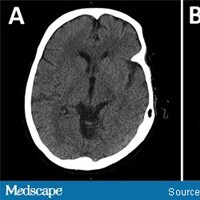 Four Human Cases of Eastern Equine Encephalitis in Connecticut, USA ...