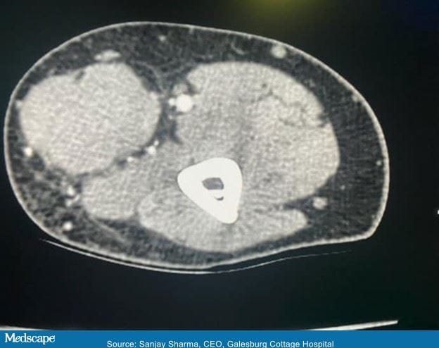 What's Causing This Rapidly Growing, Golf Ball–Sized Mass? - Page 2