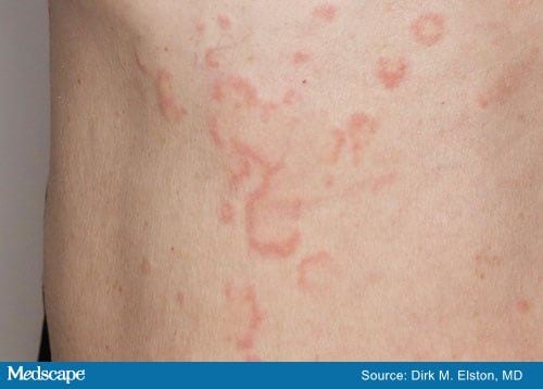 Itchy Rash and Sleep Loss