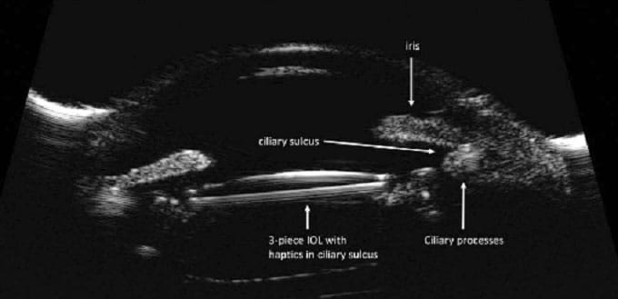 Patient and Lens Selection: An In-Depth Exploration of Intraocular ...