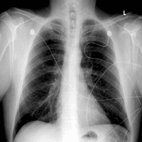 A School Nurse With Anxiety, Diarrhea, Palpitations, and Cough - Page 2