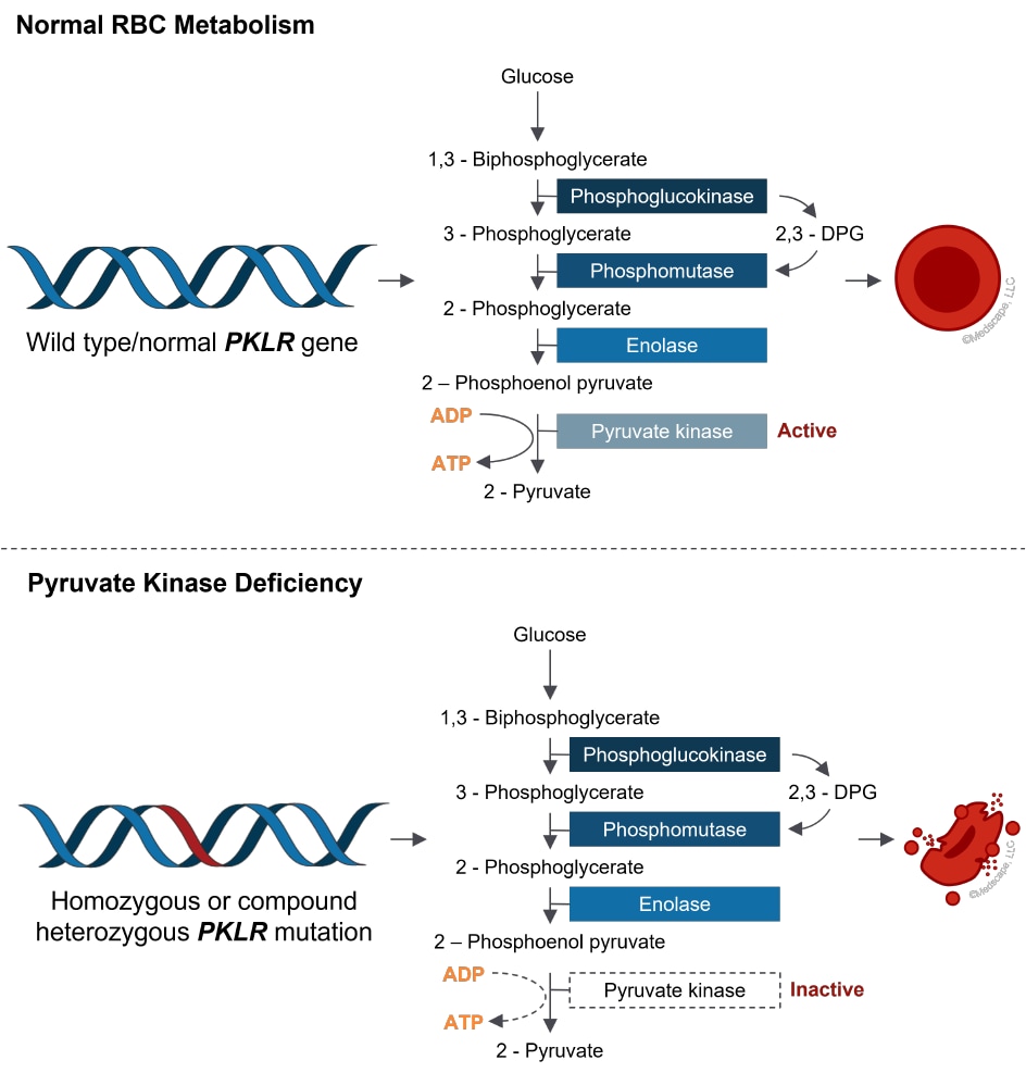 Pyruvate Kinase Deficiency: What Every Hematologist Should Know