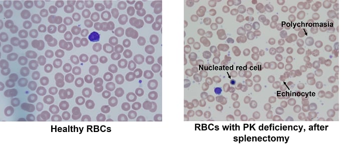 Pyruvate Kinase Deficiency: What Every Hematologist Should Know