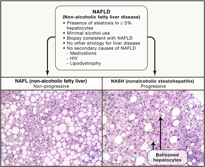 How Would You Assess These Patients for Liver Fibrosis?