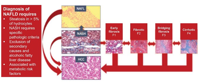 How Would You Assess These Patients for Liver Fibrosis?