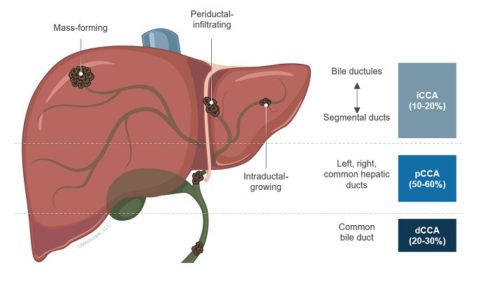 2023 Clinical Updates in Cholangiocarcinoma: Novel Approaches to ...