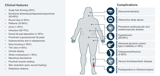 Translating Mechanisms Into Practice for Cushing Syndrome