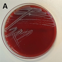 Auritidibacter ignavus, an Emerging Pathogen Associated with Chronic ...