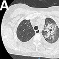 Multicenter Retrospective Study of Invasive Fusariosis in Intensive ...
