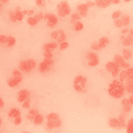 Diagnosis and Management of Gonococcemia
