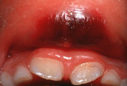 Upper Frenulum Injury Torn Frenulum Lip Toddler | Ownerlip.co