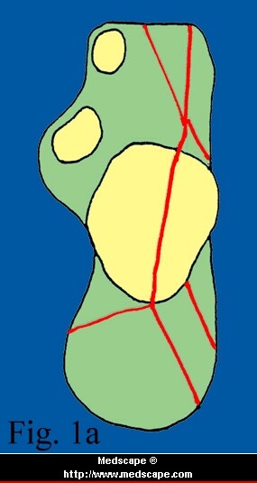 Fractures of the Os Calcis