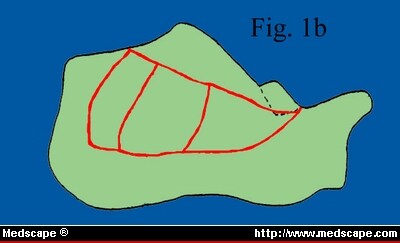 Fractures of the Os Calcis
