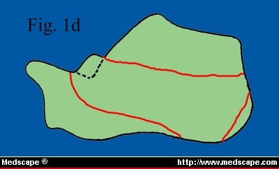 Fractures of the Os Calcis
