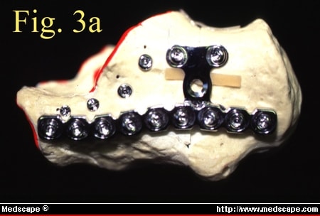 Fractures of the Os Calcis